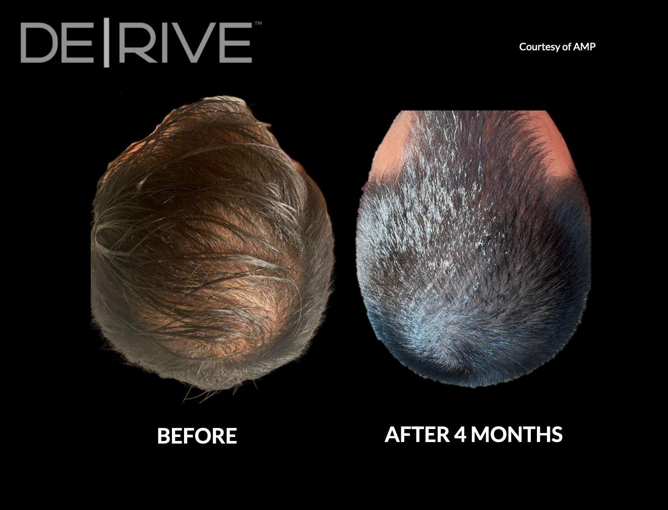Derive: Revolutionary Hair Restoration Plant Based Treatment